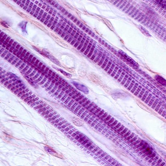Cachexia (Muscle Wasting) - San Diego Biomedical Research InstituteSan ...