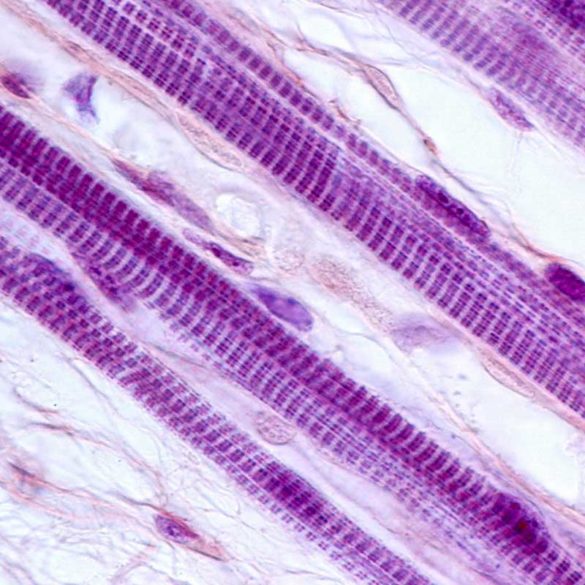 Cachexia (Muscle Wasting) - San Diego Biomedical Research InstituteSan ...